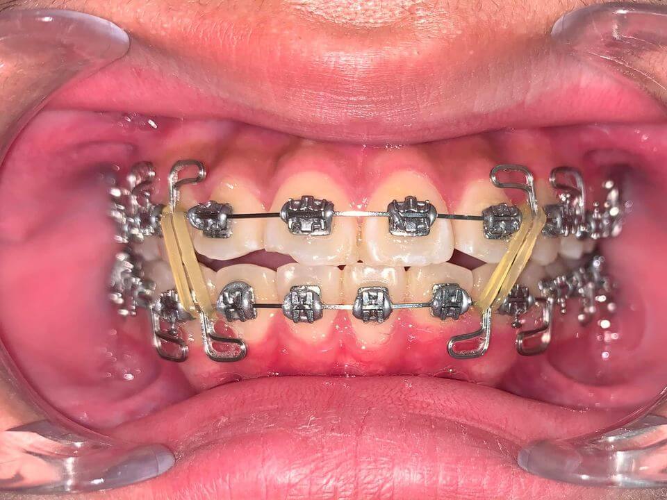 CHỈNH NHA KỸ THUẬT MEAW – GEAW – Nha Khoa Đức Hậu